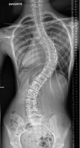 Scoliosis: Symptoms, Types, Causes, Diagnosis & Treatment in kids ...